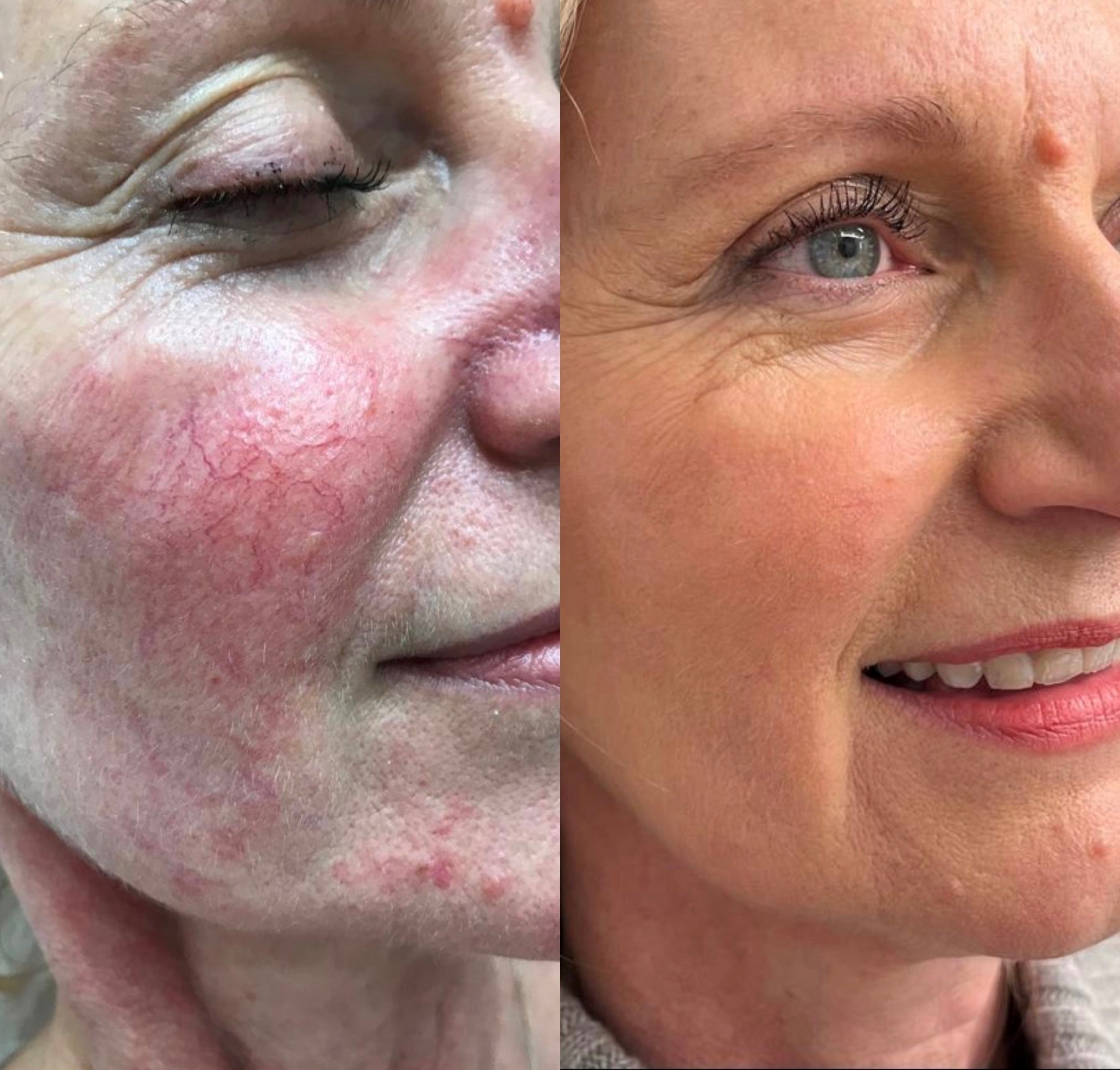 Limelight Skin Rejuvenation Shenfield | BS Medi Spa