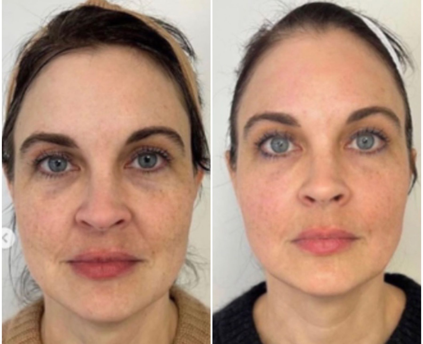 Emface Treatments Shenfield | BS Medi Spa